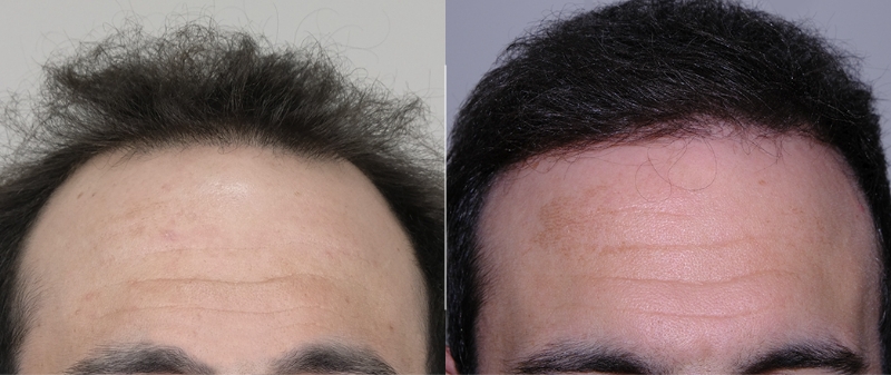VIP Hair Transplant Package