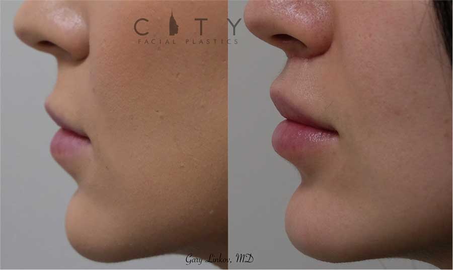 NYC Lip Lift Before and After Pictures | New York