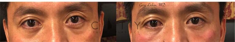 Botox and Filler Before and After | New York