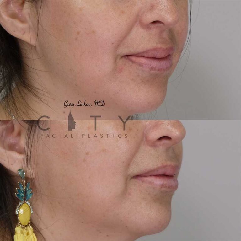 Lip Reduction in Manhattan, New York