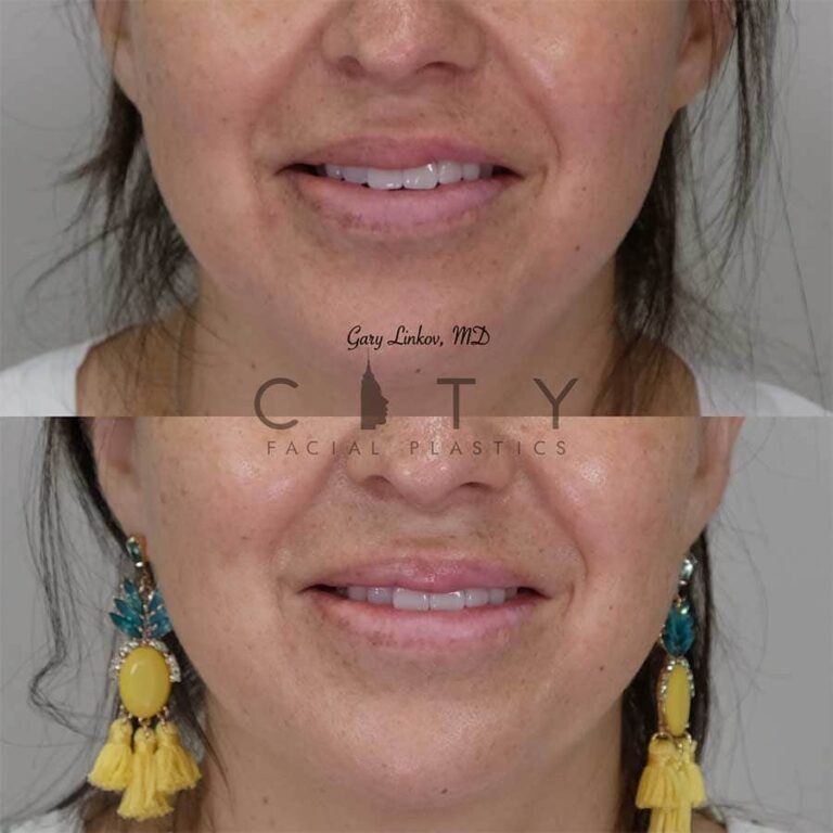 Lip Reduction in Manhattan, New York