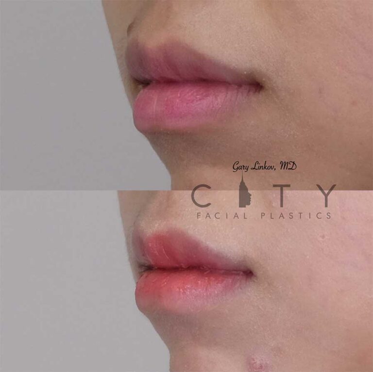 Lip Reduction in Manhattan, New York
