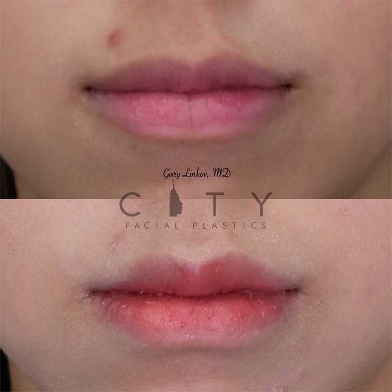 Lip Reduction in Manhattan, New York