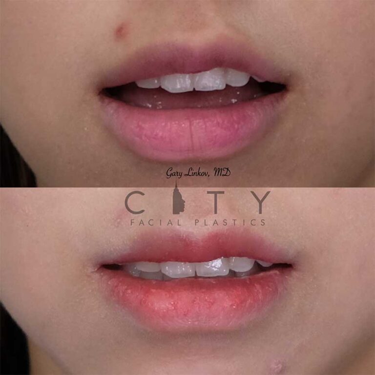 Lip Reduction in Manhattan, New York
