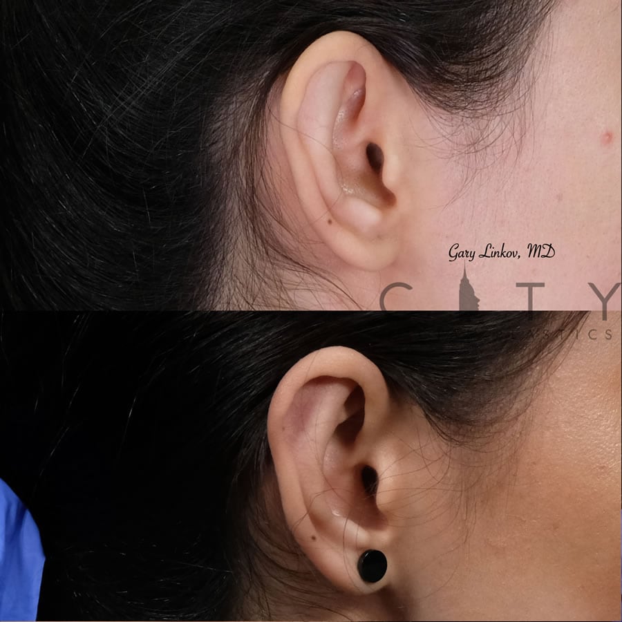 NYC Otoplasty Before and After Pictures | New York | UES