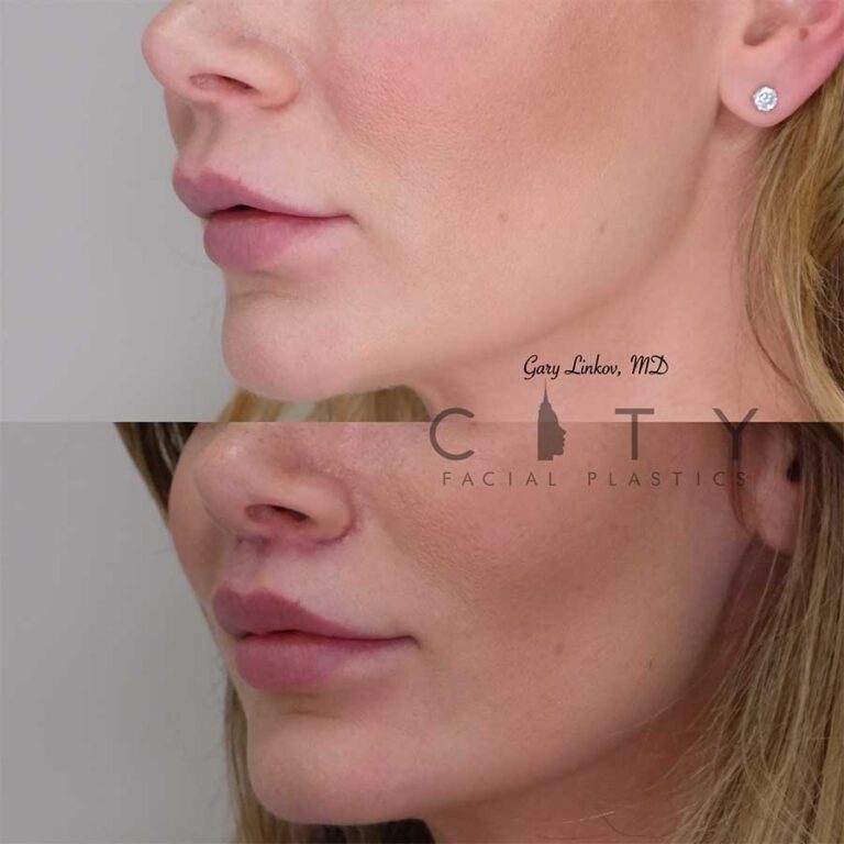 NYC Bullhorn Lip Lift Surgery | New York Subnasal Lip Enhancement