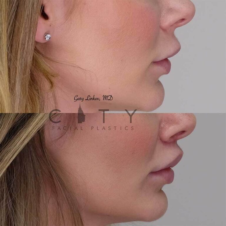 NYC Bullhorn Lip Lift Surgery | New York Subnasal Lip Enhancement