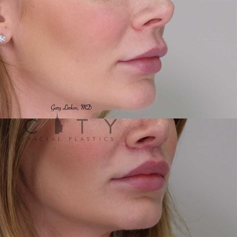 NYC Bullhorn Lip Lift Surgery | New York Subnasal Lip Enhancement