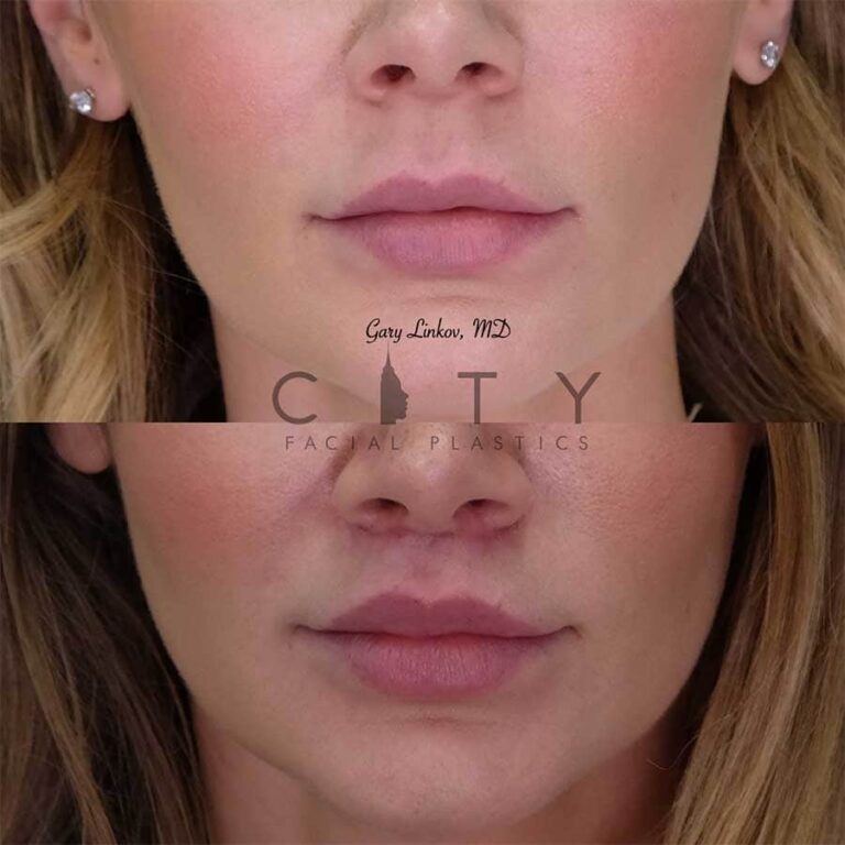 NYC Bullhorn Lip Lift Surgery | New York Subnasal Lip Enhancement
