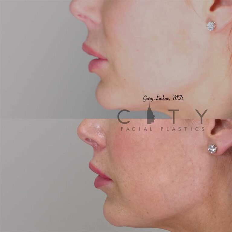 NYC Bullhorn Lip Lift Surgery | New York Subnasal Lip Enhancement