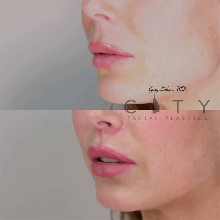 NYC Bullhorn Lip Lift Surgery | New York Subnasal Lip Enhancement