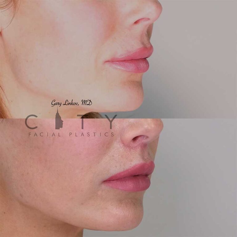 NYC Bullhorn Lip Lift Surgery | New York Subnasal Lip Enhancement