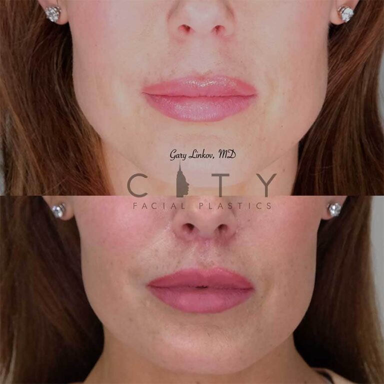 NYC Bullhorn Lip Lift Surgery | New York Subnasal Lip Enhancement