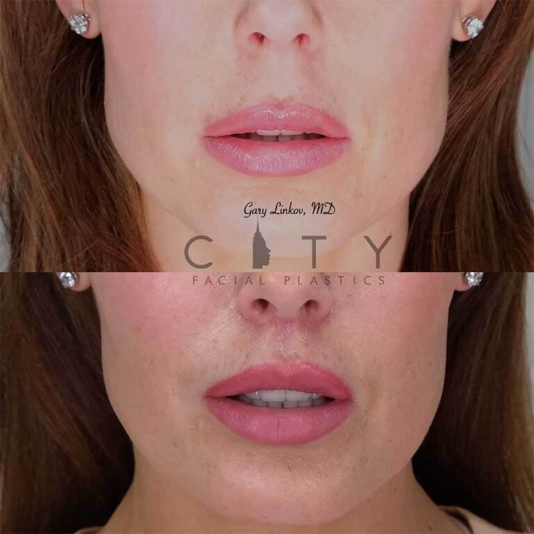 NYC Bullhorn Lip Lift Surgery | New York Subnasal Lip Enhancement