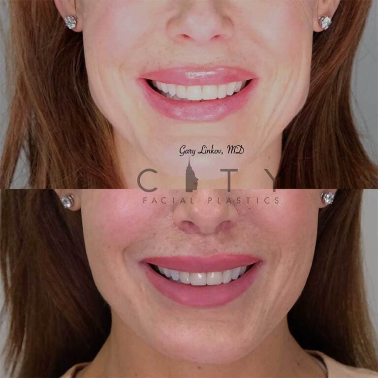 NYC Bullhorn Lip Lift Surgery | New York Subnasal Lip Enhancement