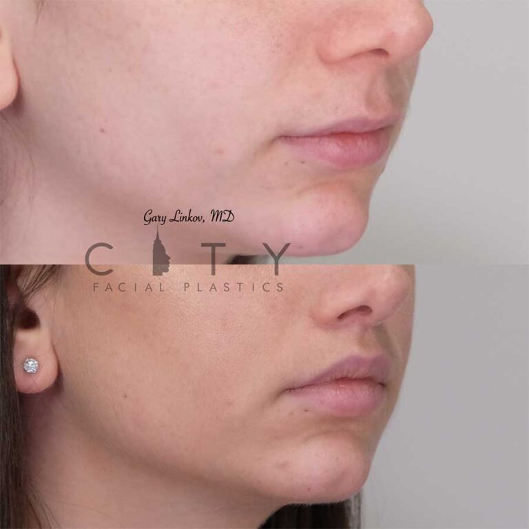 NYC Bullhorn Lip Lift Surgery | New York Subnasal Lip Enhancement