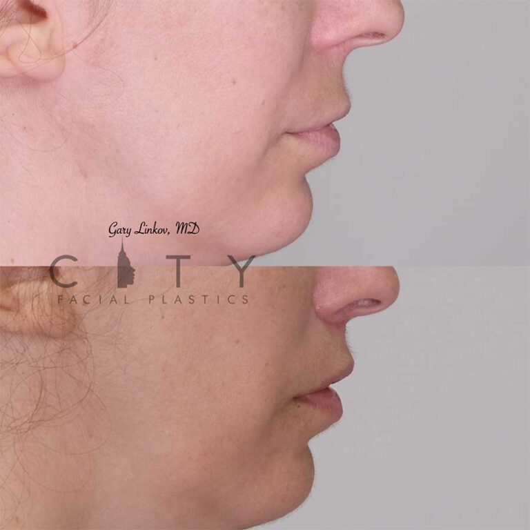 NYC Bullhorn Lip Lift Surgery | New York Subnasal Lip Enhancement