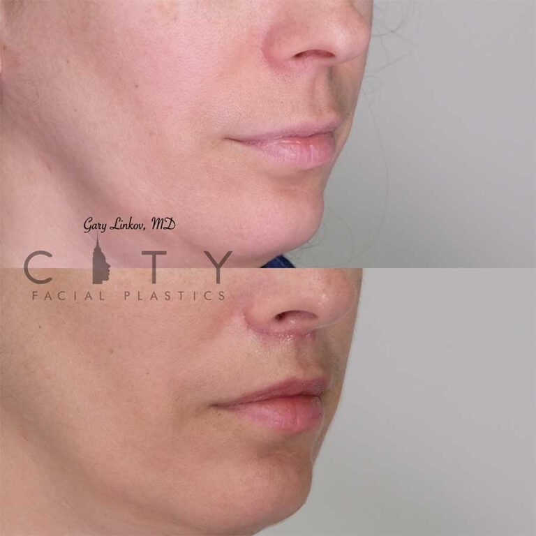 NYC Bullhorn Lip Lift Surgery | New York Subnasal Lip Enhancement