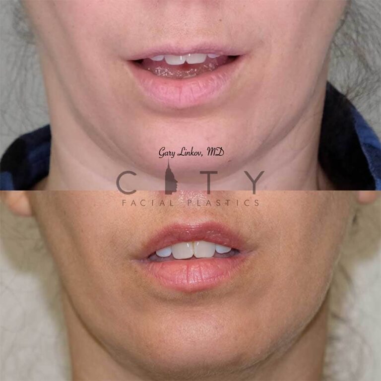 NYC Bullhorn Lip Lift Surgery | New York Subnasal Lip Enhancement