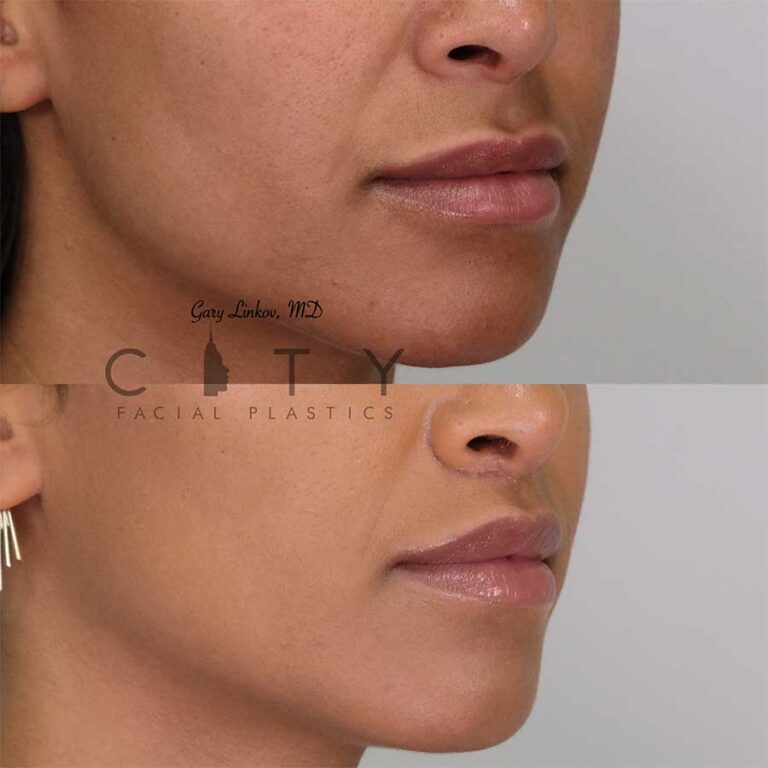 NYC Bullhorn Lip Lift Surgery | New York Subnasal Lip Enhancement