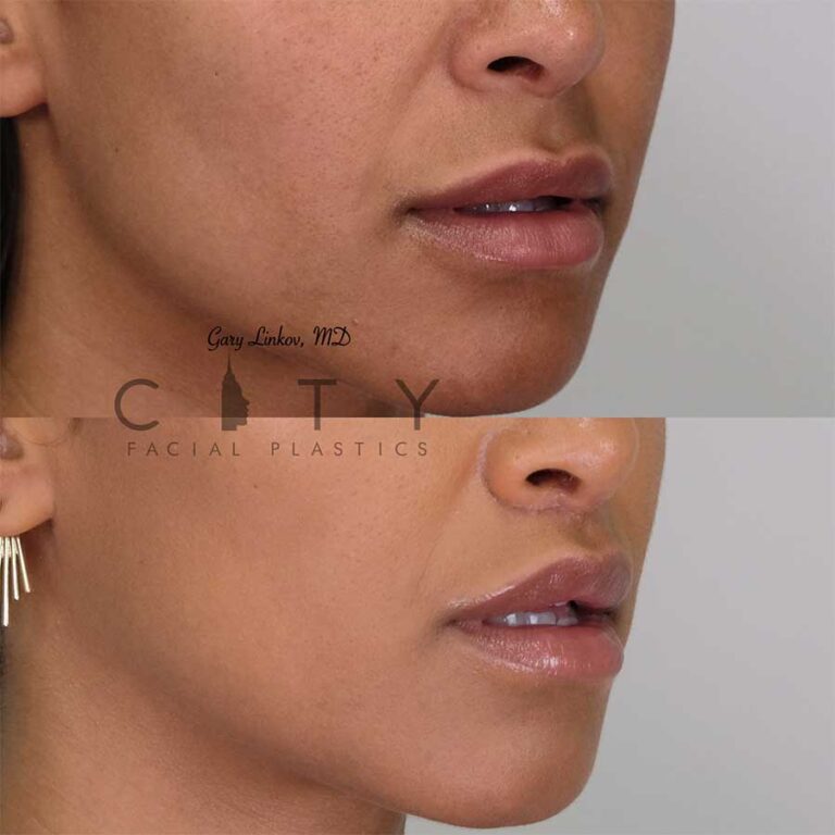 NYC Bullhorn Lip Lift Surgery | New York Subnasal Lip Enhancement