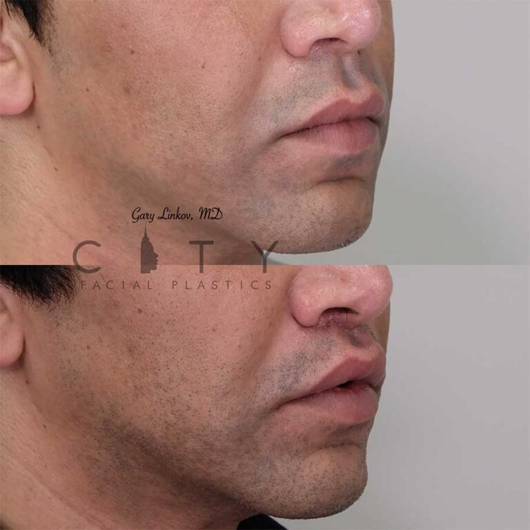 NYC Male Lip Lift | UES Male Lip Enhancement, Augmentation Surgery