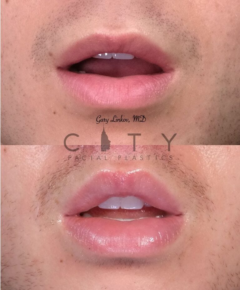 NYC Male Lip Lift | UES Male Lip Enhancement, Augmentation Surgery
