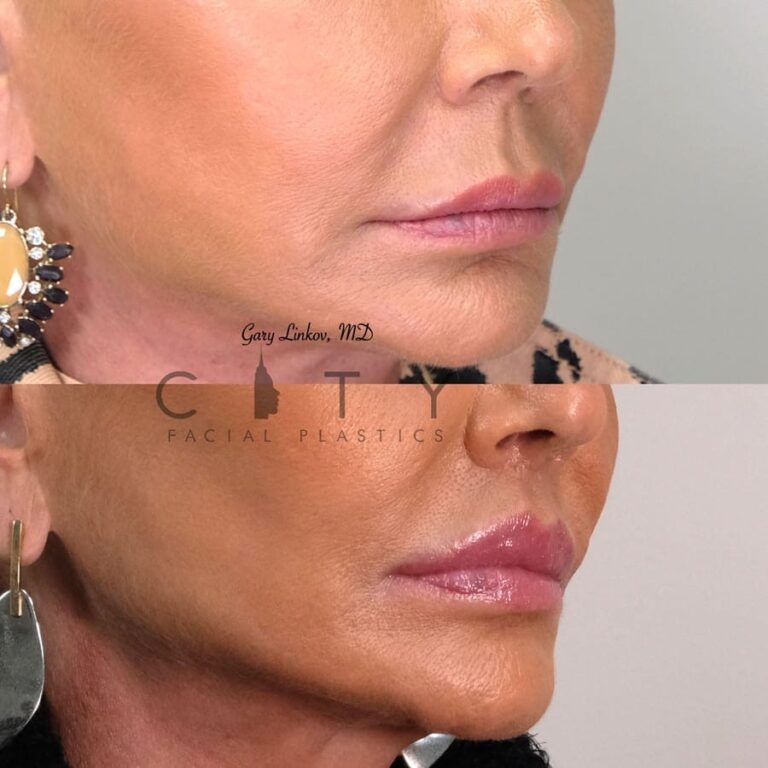 Elelyft Upper Lip Lift | Dr. Gary Linkov Facial Plastic Surgeon | New York