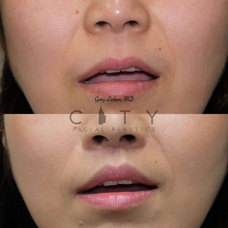 Elelyft Upper Lip Lift | Dr. Gary Linkov Facial Plastic Surgeon | New York