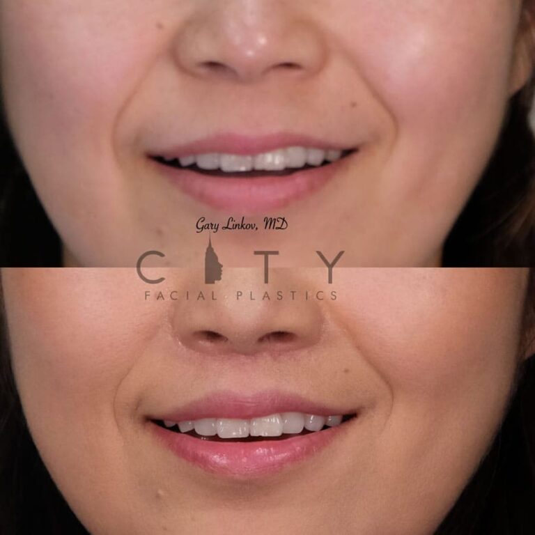 Elelyft Upper Lip Lift | Dr. Gary Linkov Facial Plastic Surgeon | New York