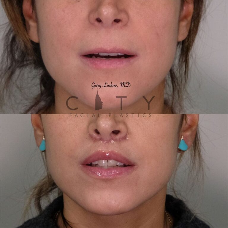 Elelyft Upper Lip Lift | Dr. Gary Linkov Facial Plastic Surgeon | New York