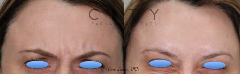 NYC Facial Fillers Dermal Injections | New York Lip Fillers | UES