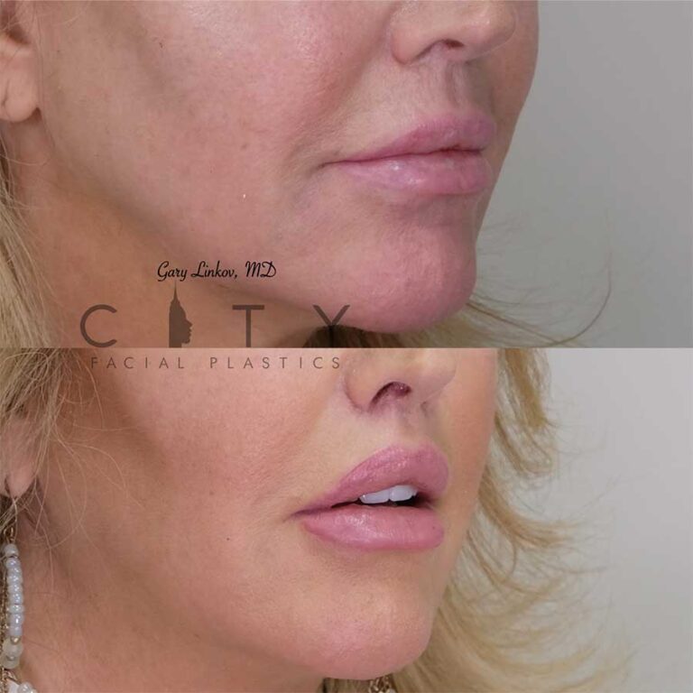 NYC Lip Lift Revision Surgery | UES Lip Lift Scar Repair | Cosmetic Surgery