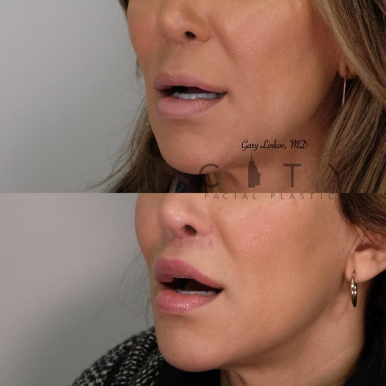 NYC Lip Lift Revision Surgery | UES Lip Lift Scar Repair | Cosmetic Surgery