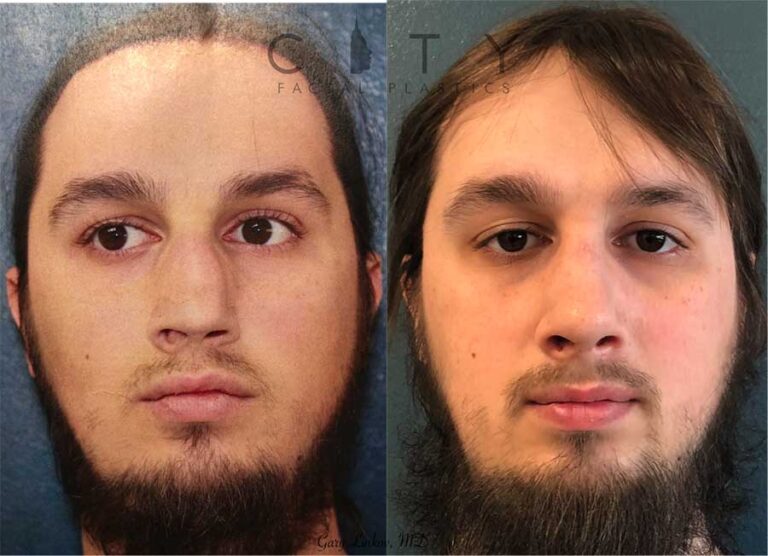 NYC Male Facial Plastic Surgery | New York Male Cosmetic Surgeon