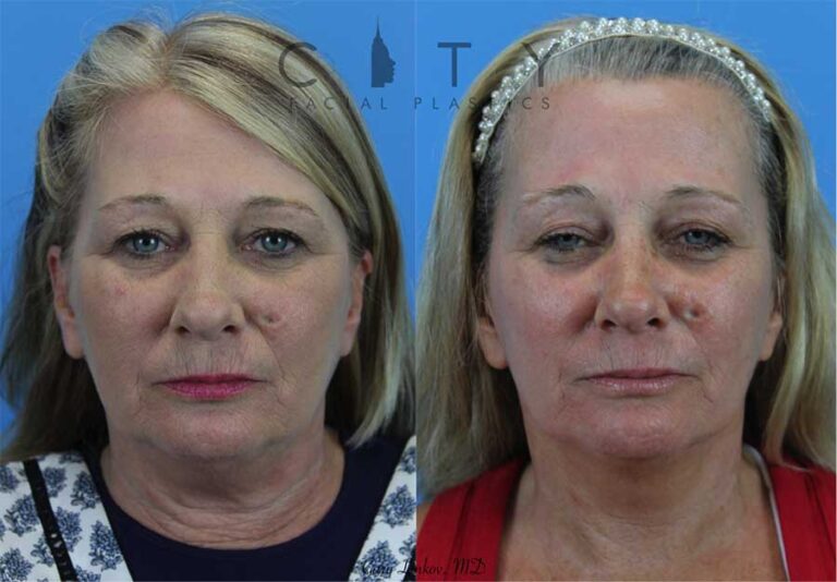 NYC Neck Lift Surgery | New York Lower Rhytidectomy | UES