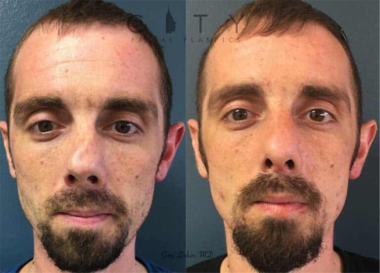 NYC Deviated Septum Surgery | New York Septoplasty Repair | UES