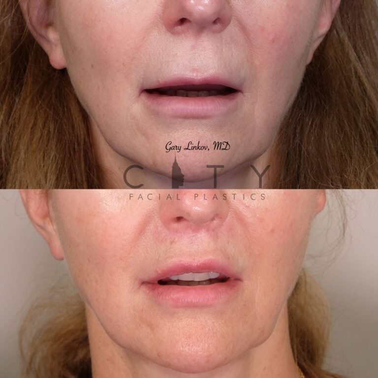 Elelyft Upper Lip Lift | Dr. Gary Linkov Facial Plastic Surgeon | New York