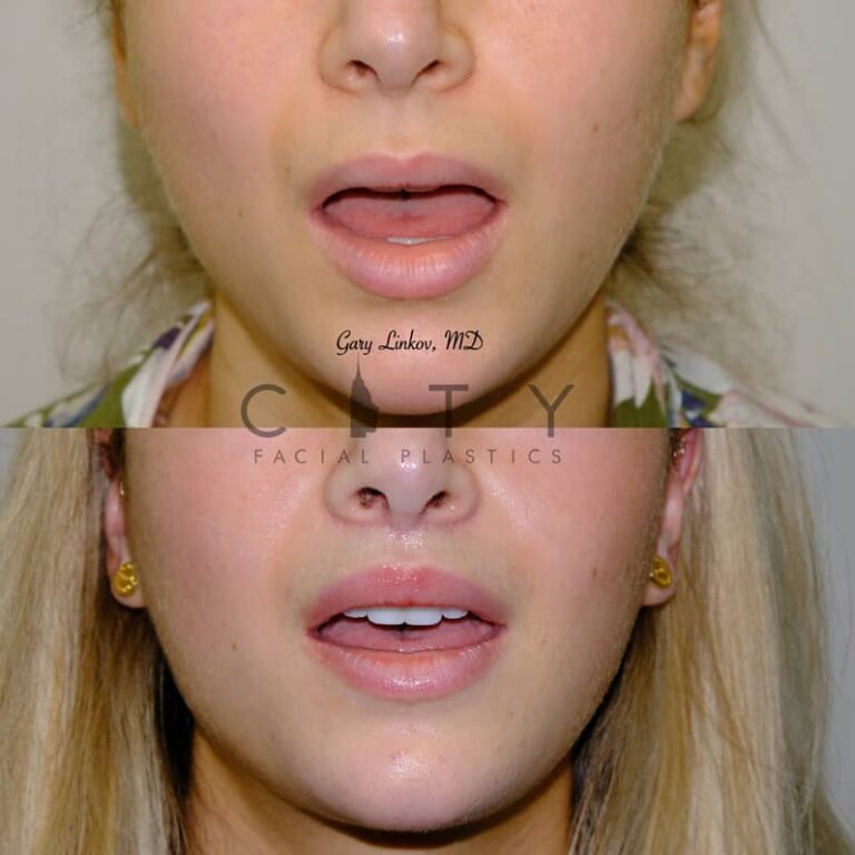 Lip Lift Before and After | New York Plastic Surgeon Dr. Linkov