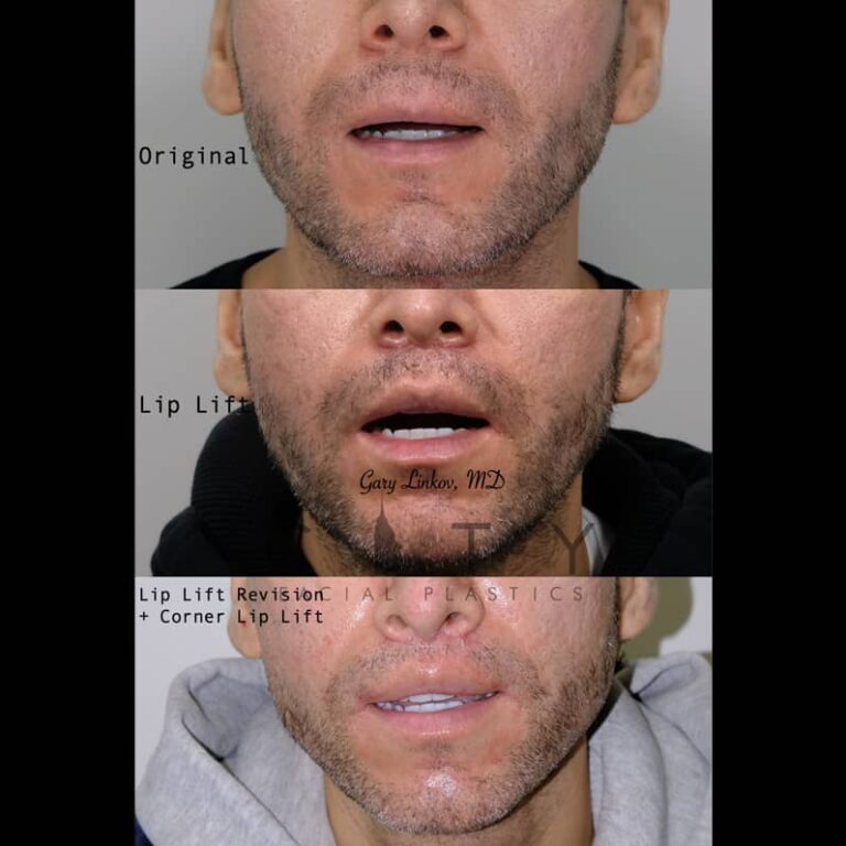 Lip Lift Before and After | New York Plastic Surgeon Dr. Linkov