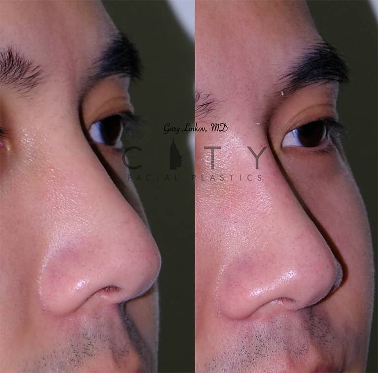 Botox and Filler Before and After | New York