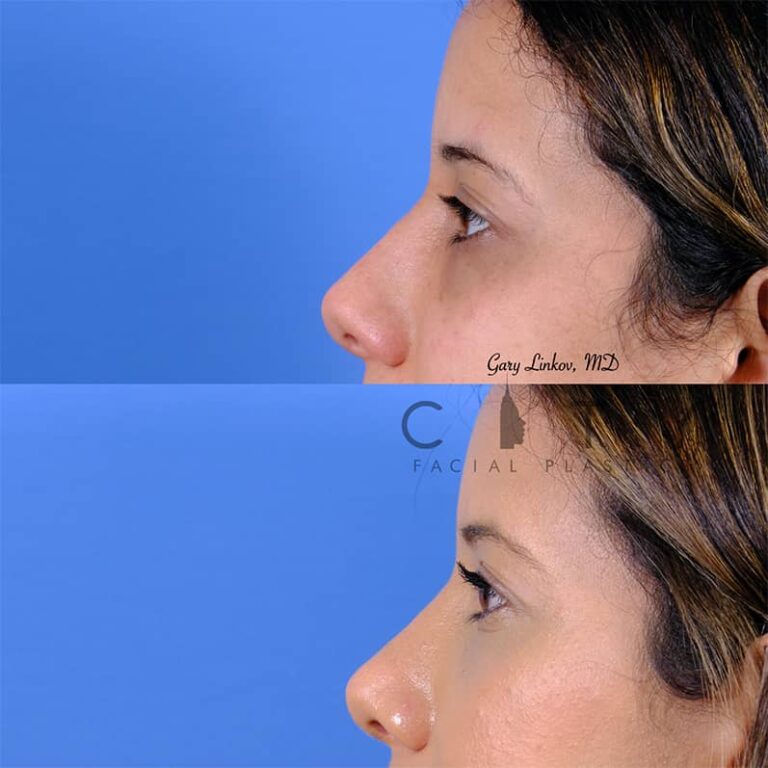 NYC Nasal Surgery (Rhinoplasty) Before and After Pictures - New York - UES