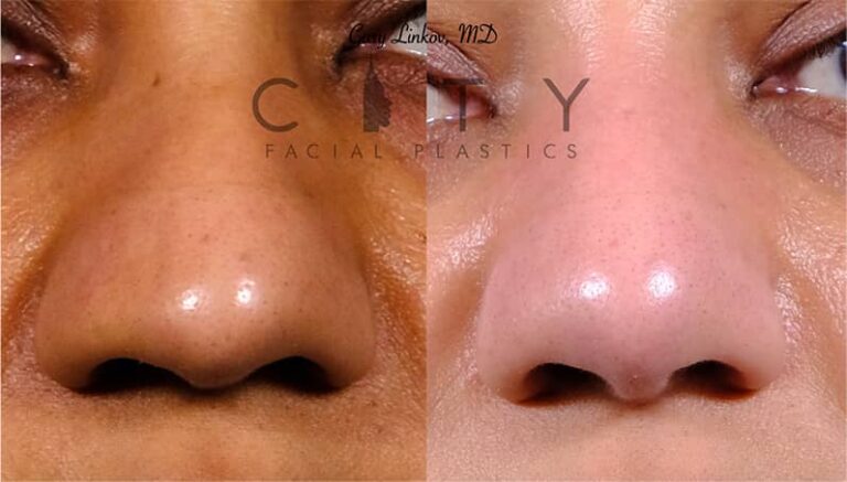 NYC Nasal Surgery (Rhinoplasty) Before and After Pictures - New York - UES