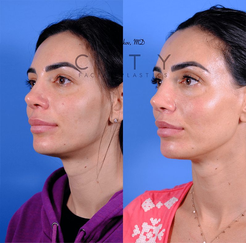 Lip Lift Before and After | New York Plastic Surgeon Dr. Linkov
