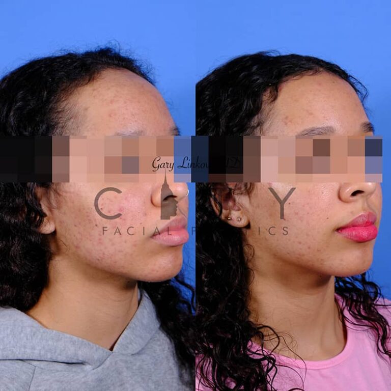 NYC Hairline Lowering/Advancement | New York Forehead Reduction | UES