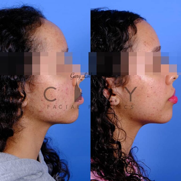 NYC Hairline Lowering/Advancement | New York Forehead Reduction | UES