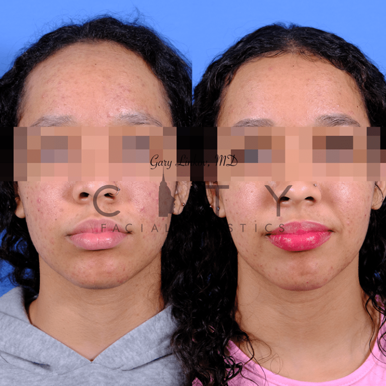 NYC Hairline Lowering/Advancement | New York Forehead Reduction | UES
