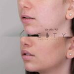 NYC Bullhorn Lip Lift Surgery | New York Subnasal Lip Enhancement