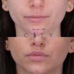 NYC Bullhorn Lip Lift Surgery | New York Subnasal Lip Enhancement