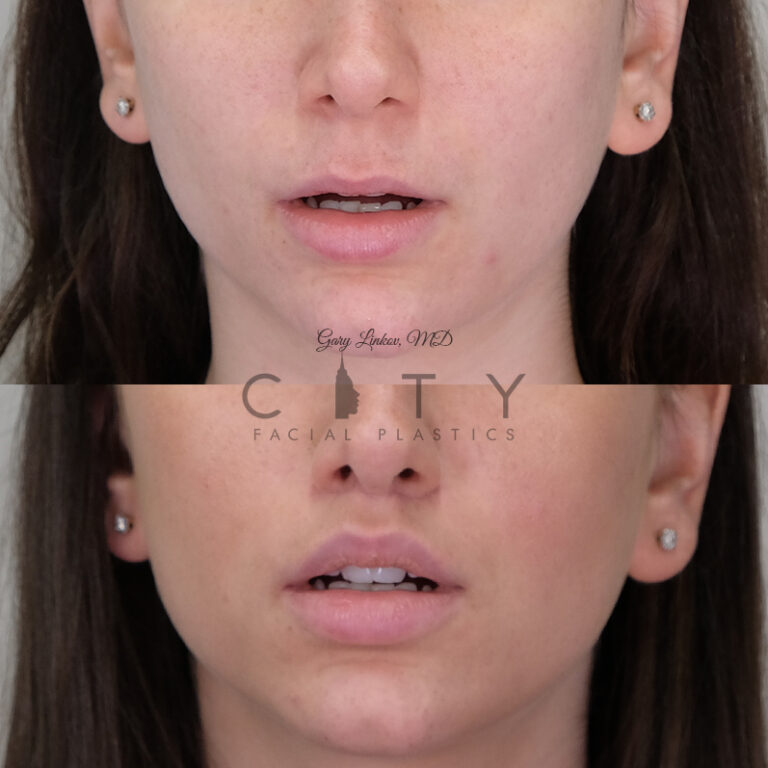 NYC Bullhorn Lip Lift Surgery | New York Subnasal Lip Enhancement